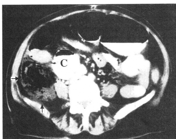 מורסות בצפק - Peritoneal abscess – ויקירפואה