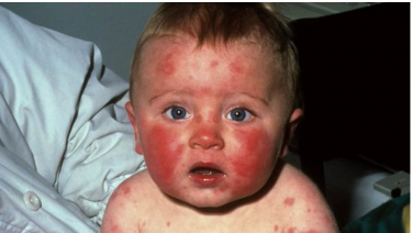 Parvovirus B19 Antibodies, IgG - medpage