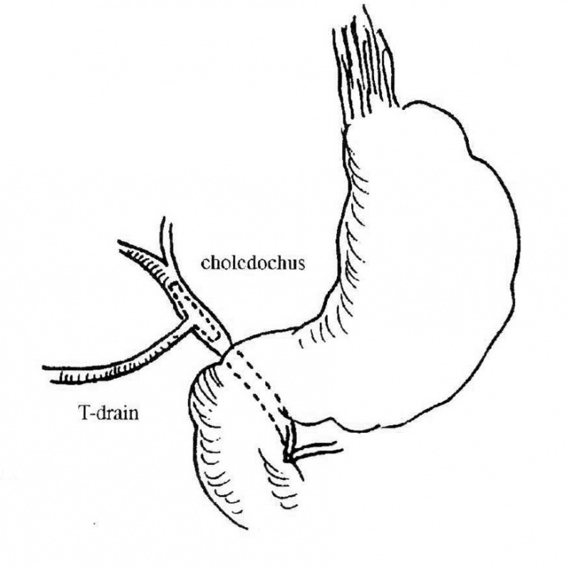 אבנים בדרכי המרה - Choledocholithiasis – ויקירפואה